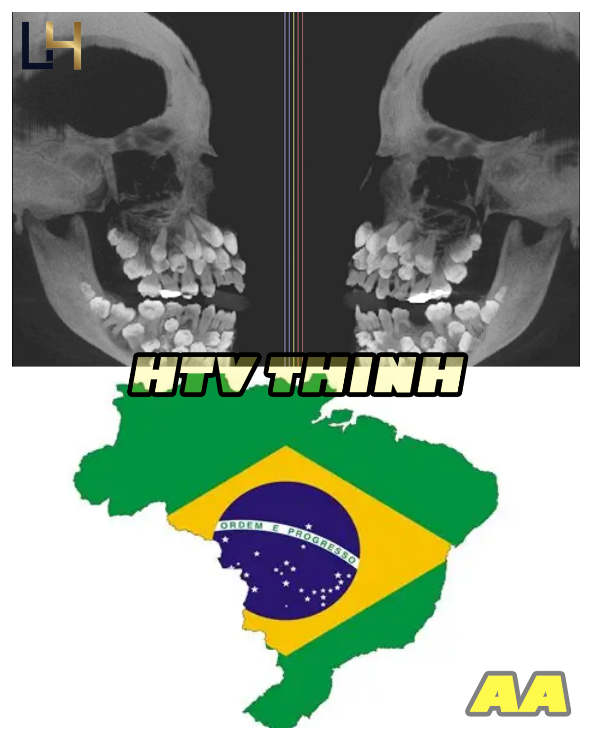 A Rare Medical Marvel: Brazilian Girl Found with 81 Teeth in Her Mouth ...